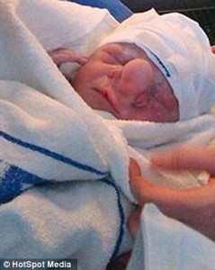 Pinnochio Baby: Toddler born with rare birth defect, has brain growing ...