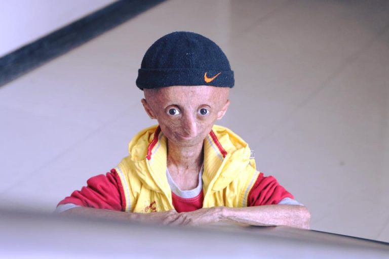 India's face of progeria 15 year old Nihal Bitla is no more - DailyRounds