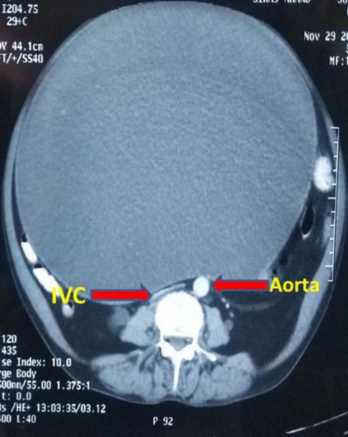 Doctors save a man suffering from ‘giant bladder’, six times bigger ...