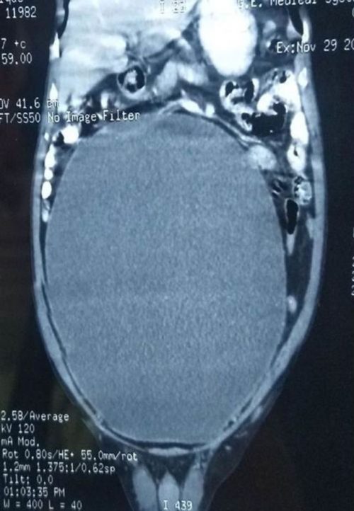 Doctors save a man suffering from ‘giant bladder’, six times bigger ...