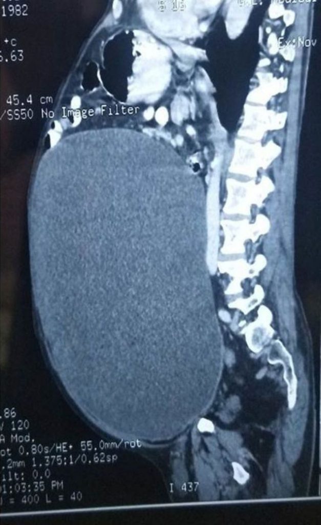 Doctors save a man suffering from ‘giant bladder’, six times bigger ...