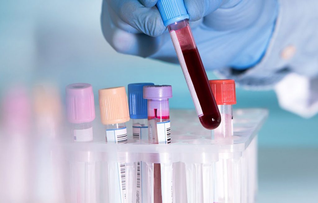 New Blood Test For Prostate Cancer Could Reduce Biopsies DailyRounds new-blood-test-for-prostate-cancer-could-reduce-biopsies-dailyrounds