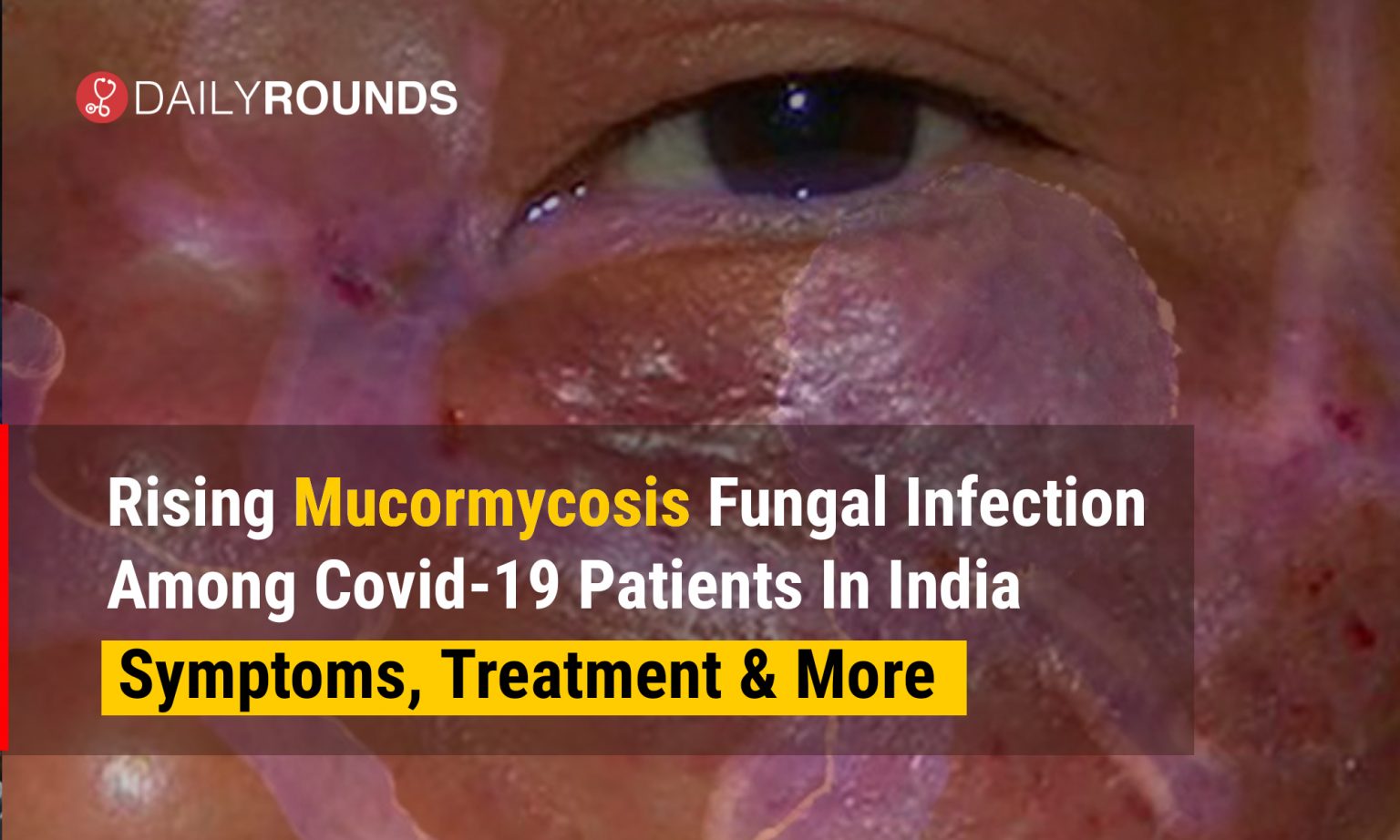 Rising Mucormycosis Fungal Infection Among COVID-19 Patients In India ...